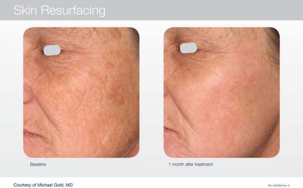 Laser Treatments - Sun Dermatology : Panama City, Florida