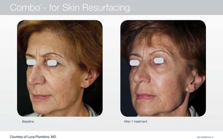 Laser Treatments - Sun Dermatology : Panama City, Florida