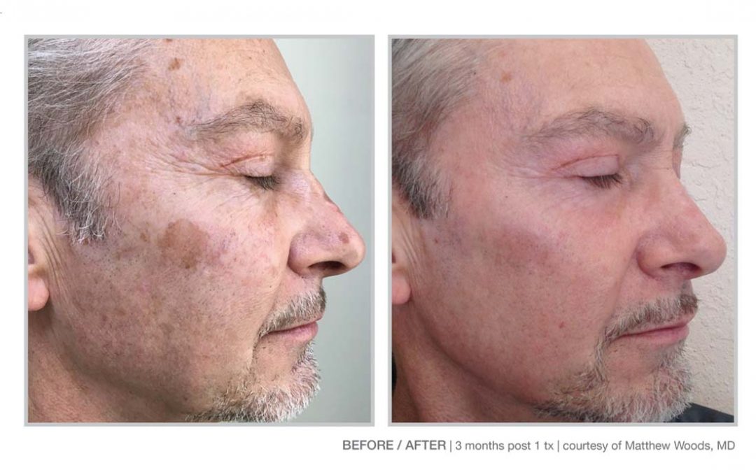 Laser Treatments - Sun Dermatology : Panama City, Florida