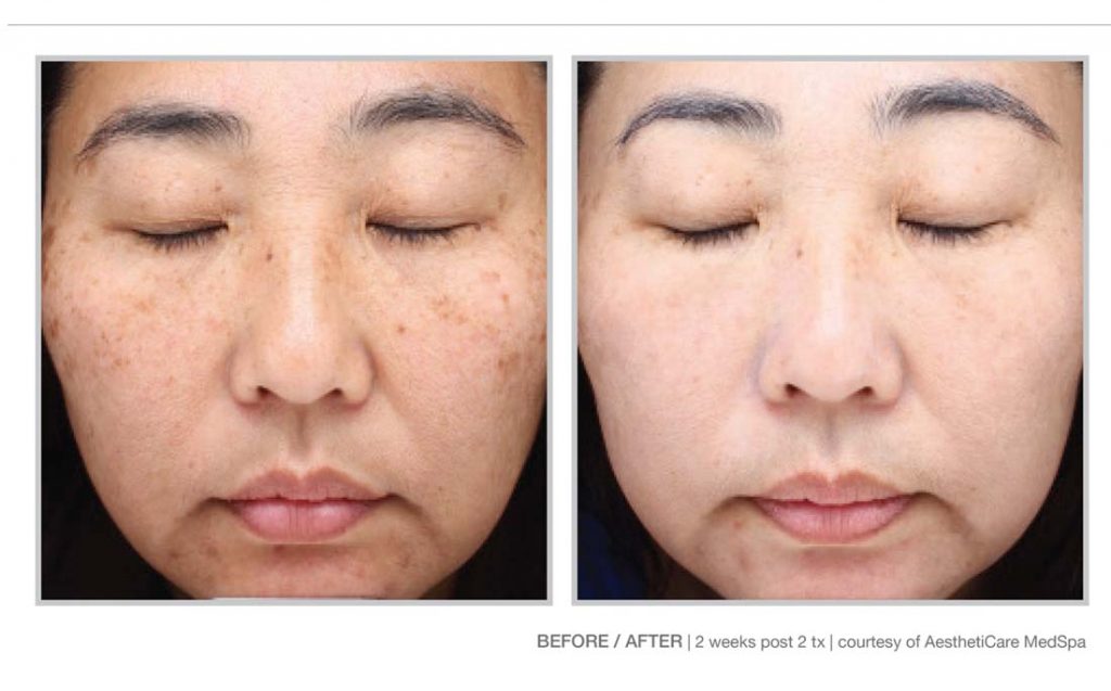 Laser Treatments - Sun Dermatology : Panama City, Florida
