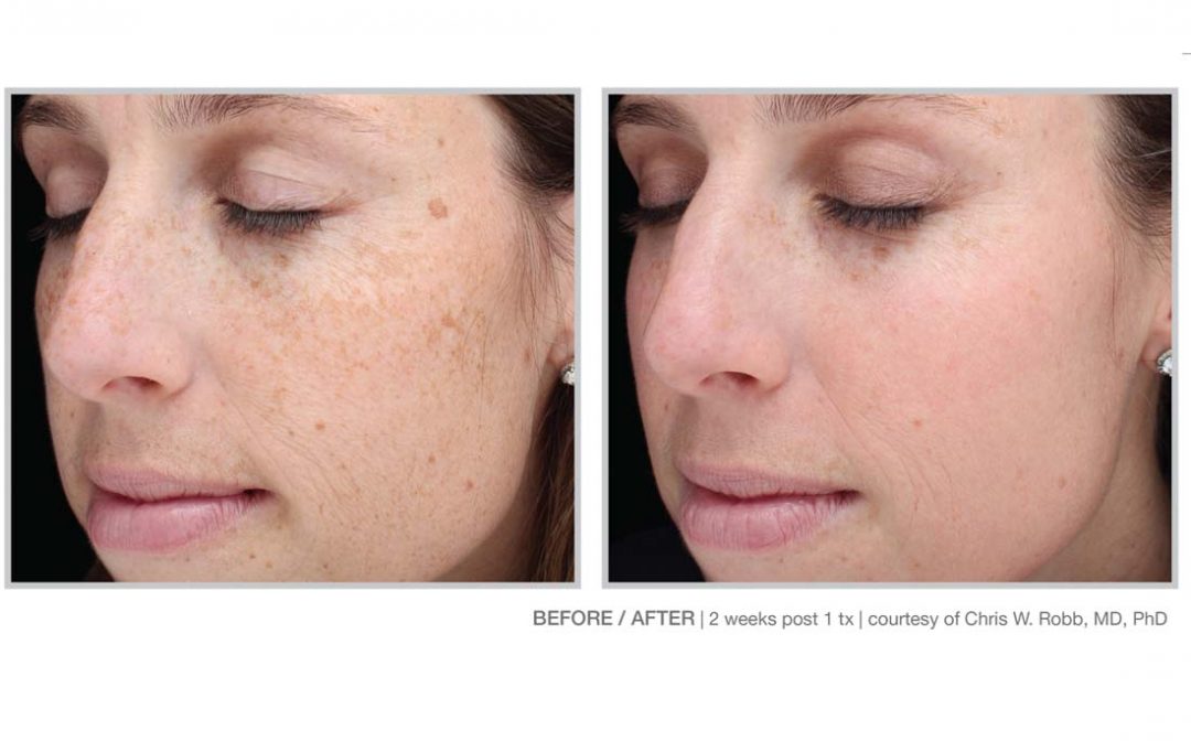 Laser Treatments - Sun Dermatology : Panama City, Florida
