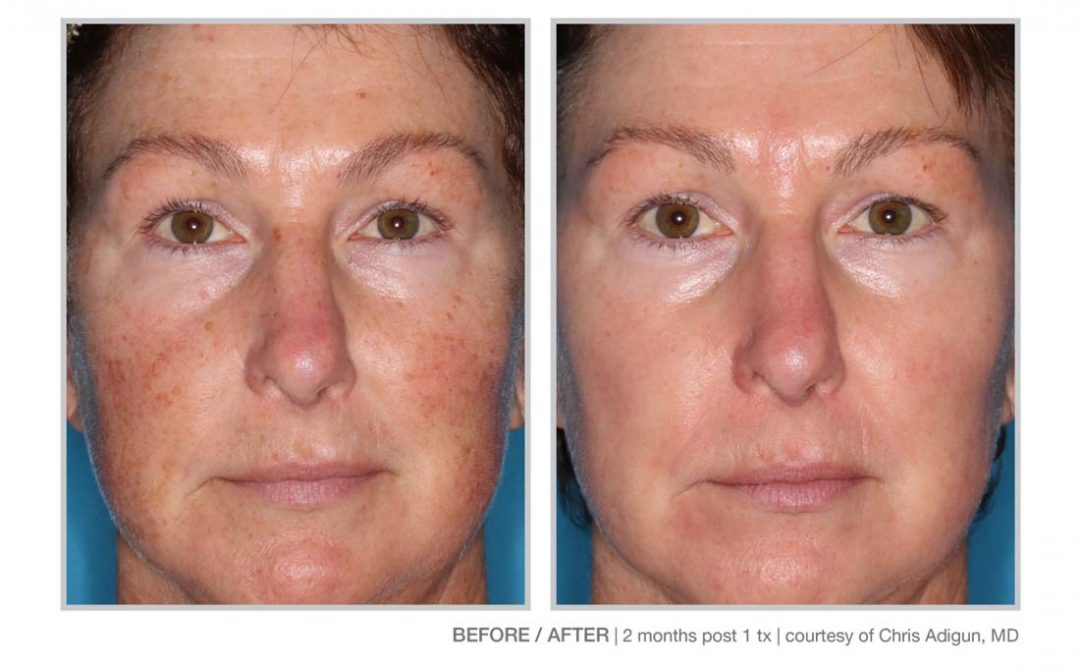 Laser Treatments - Sun Dermatology : Panama City, Florida